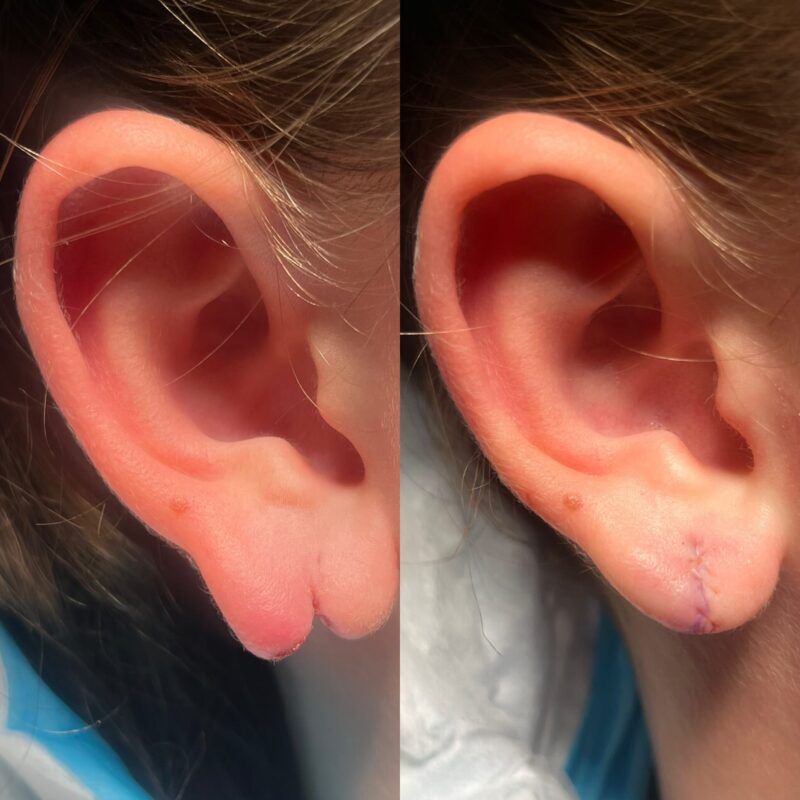 Ear Lobe Repair - Priya Nayyar, M.D.